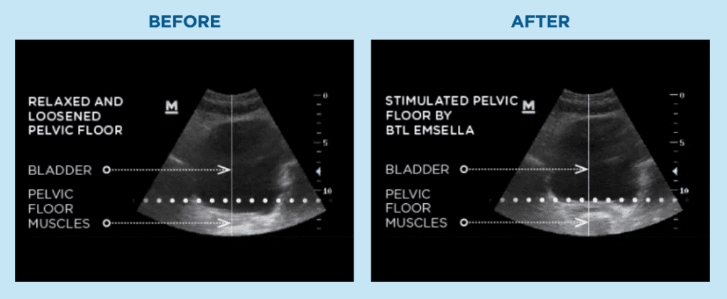 EMSELLA Nonsurgical Urinary Incontinence Treatment Minnesota