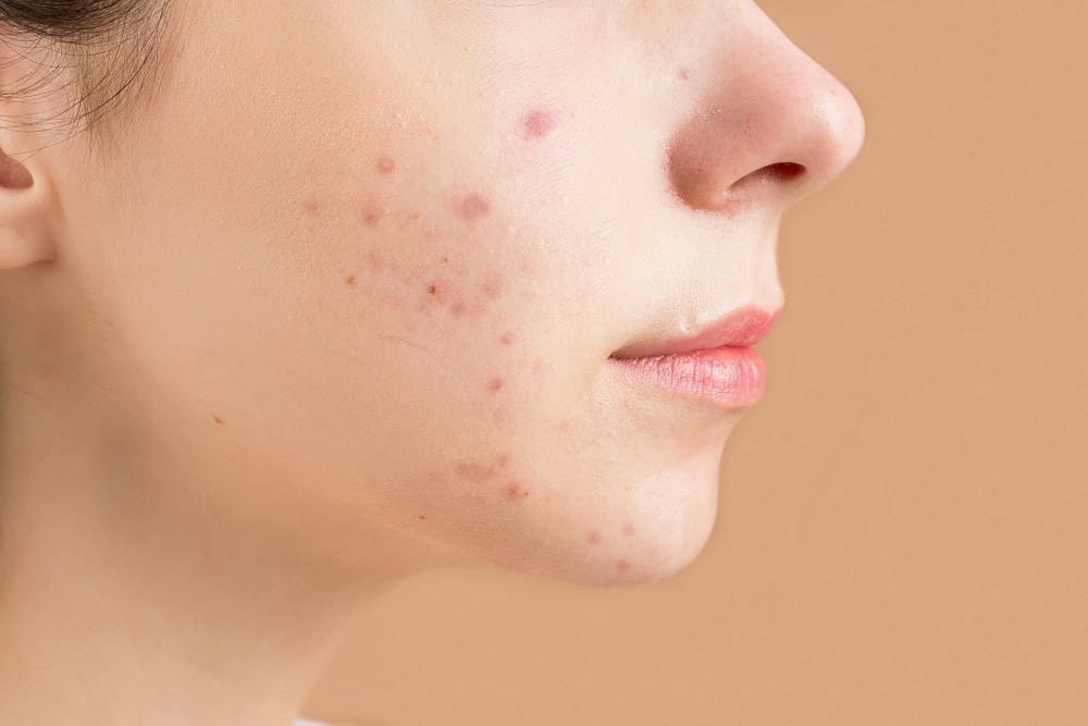 How to Tackle Post-Inflammatory Hyperpigmentation